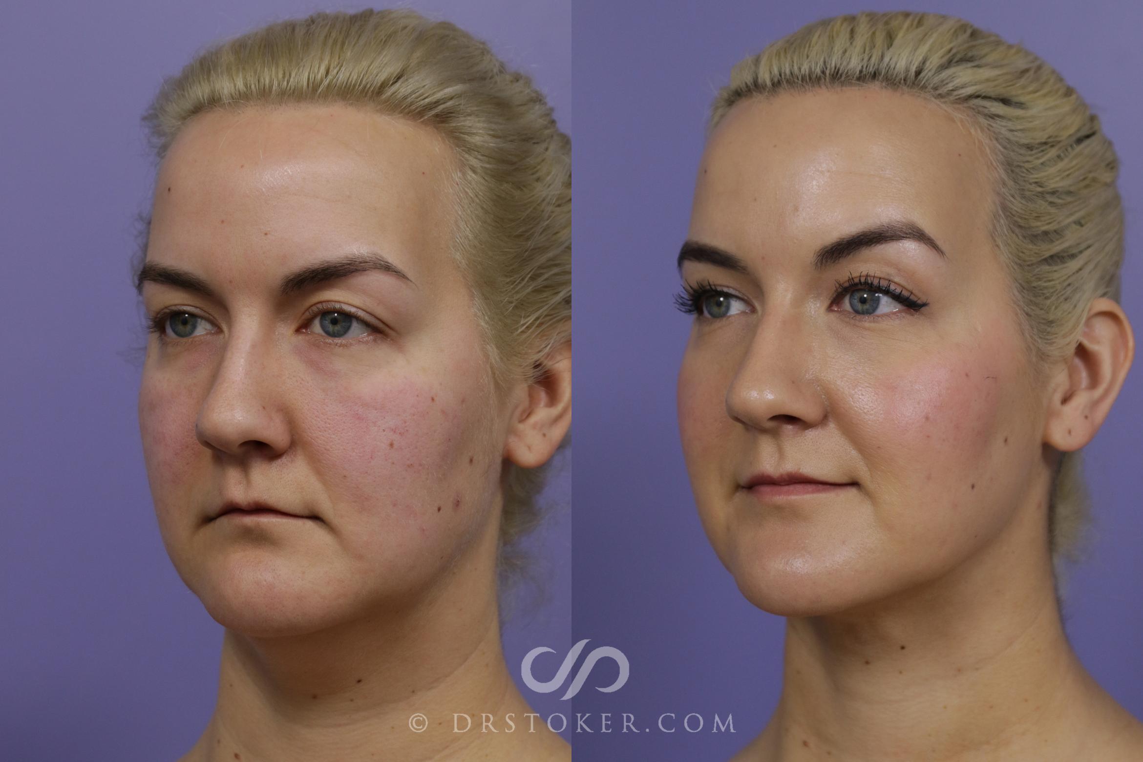 Cheek/Chin Shaping Case #1560