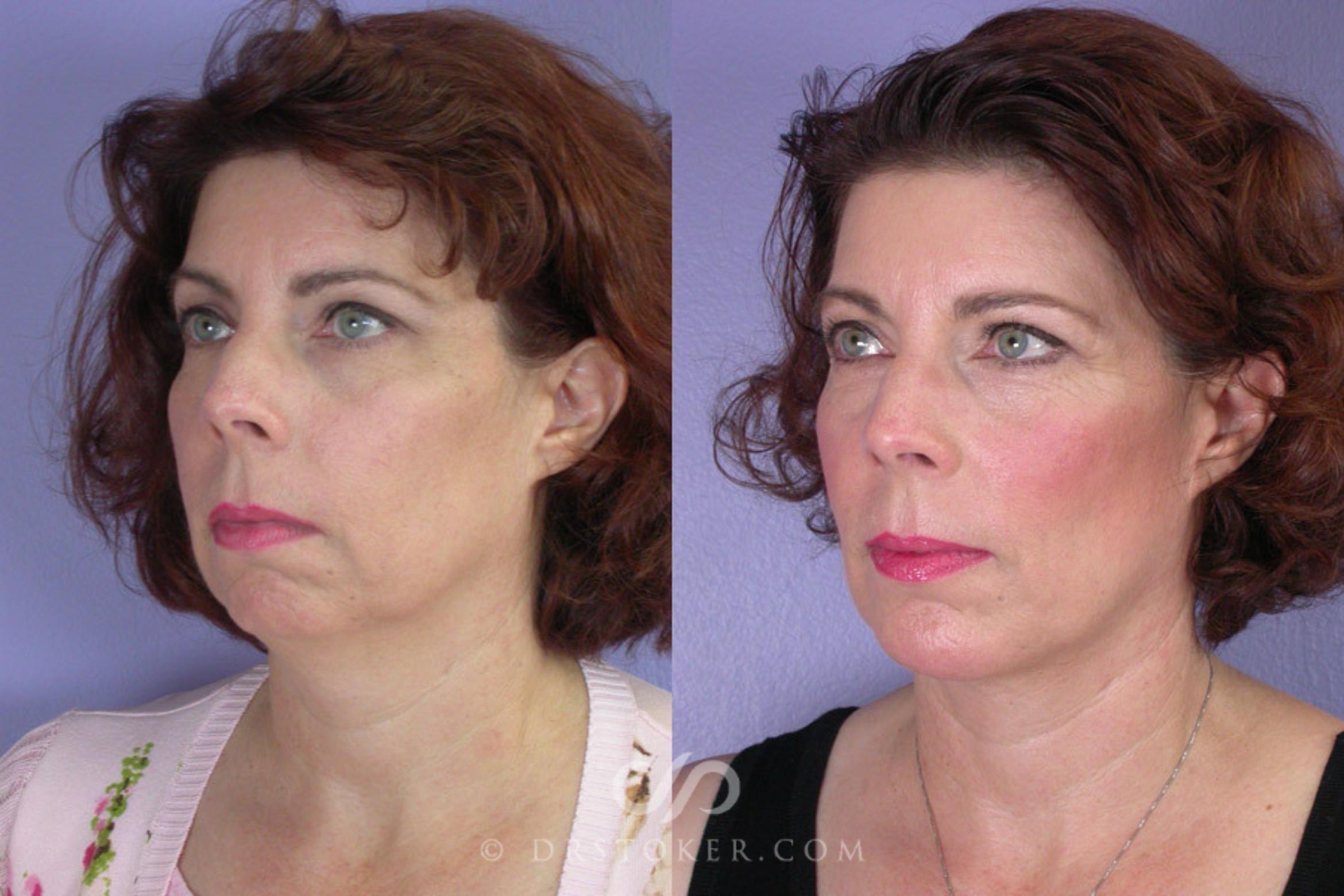 Cheek/Chin Contouring Before and After Pictures Case 258 | Los Angeles ...