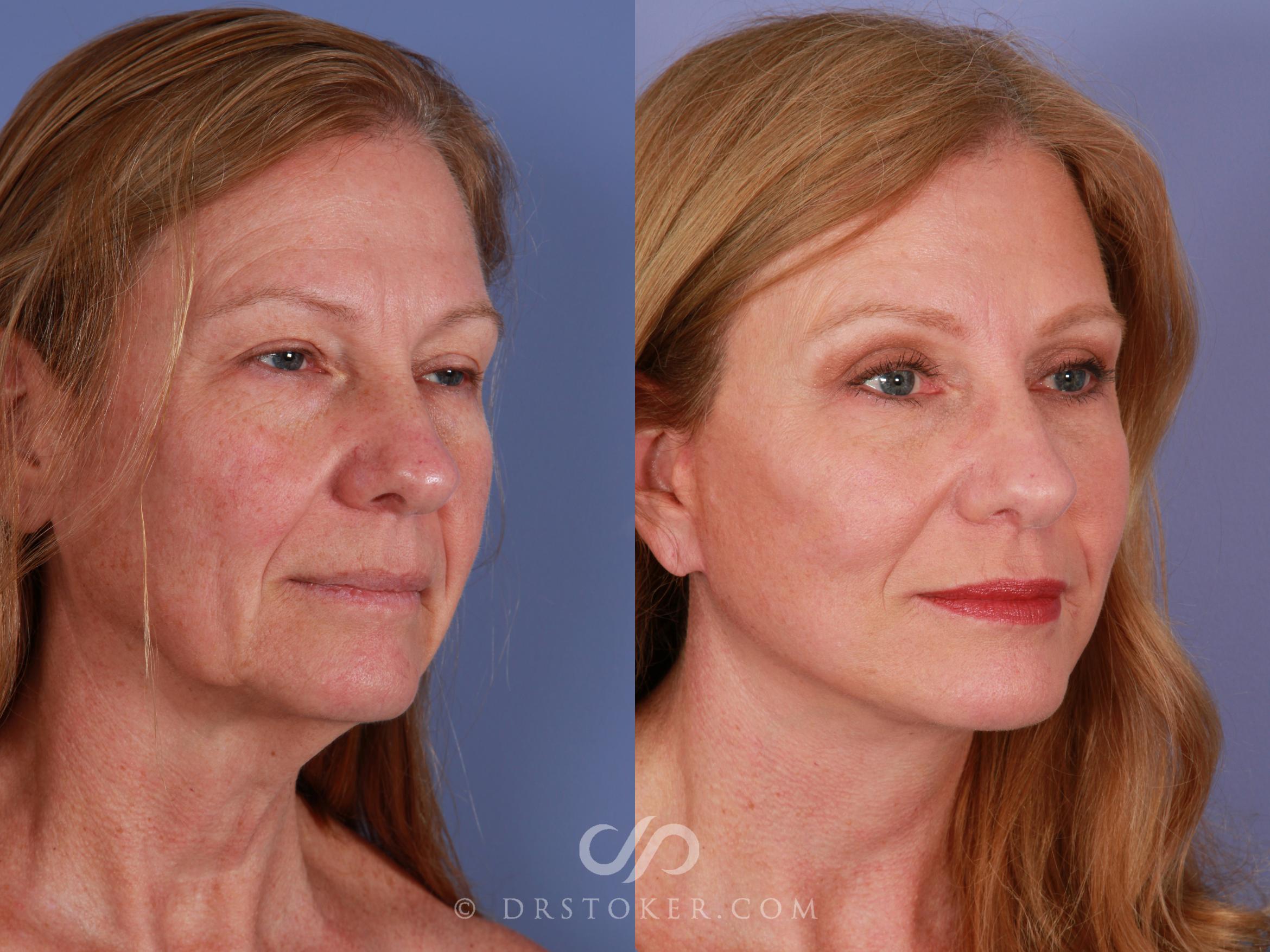 Neck Lift - Traceless Neck Lift Before and After Pictures Case 802 ...
